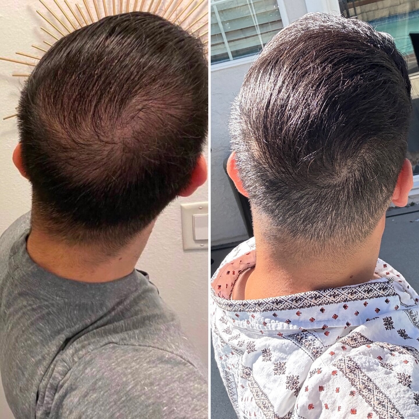 Xyon 2% Dutasteride Siloxysytem Gel Journey - Hair Loss Drugs - Hair ...