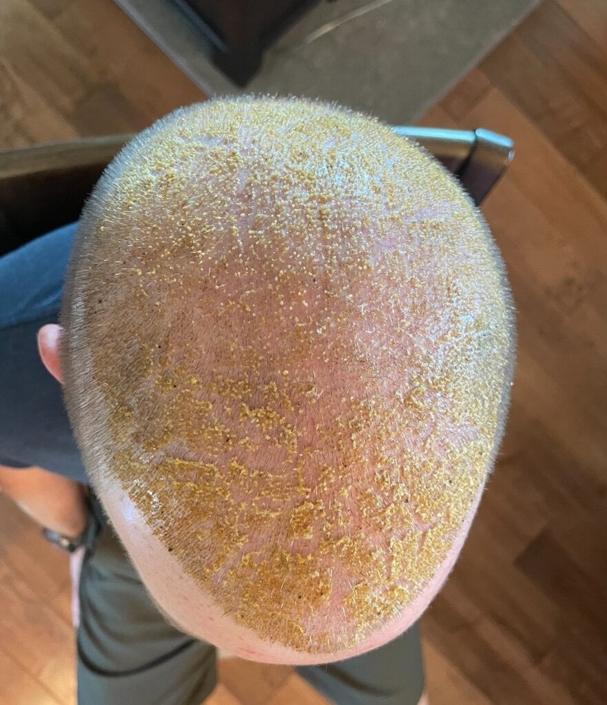 Dr Pittella, 2 days, 14,487 grafts. - Hair Transplant Reviews - Hair ...
