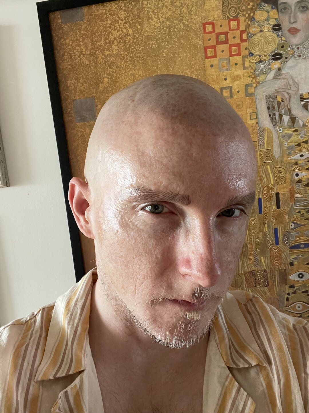 Marzena Kojder at Westminster medical group - Scalp Micropigmentation ...