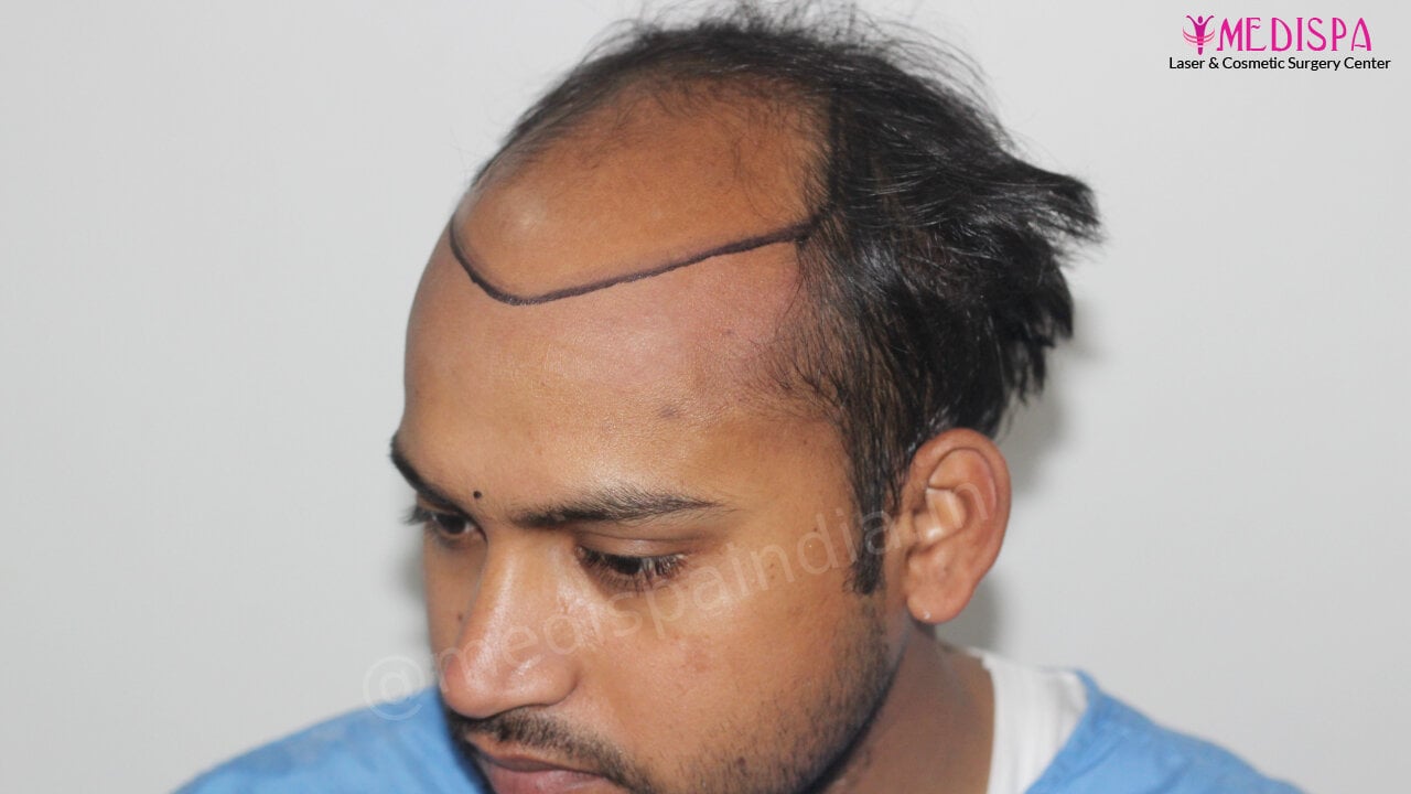 Dr. Suneet Soni - 5587 Grafts, Combine FUT + FUE + Beard Technique, NW ...