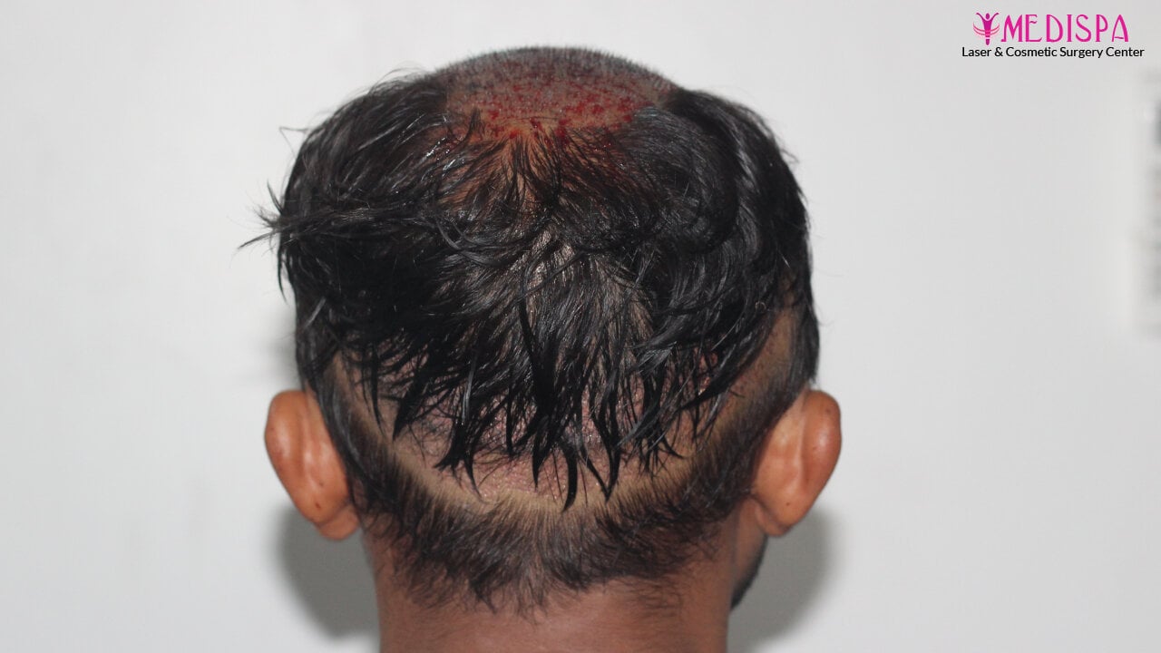 Dr. Suneet Soni - 5587 Grafts, Combine FUT + FUE + Beard Technique, NW ...