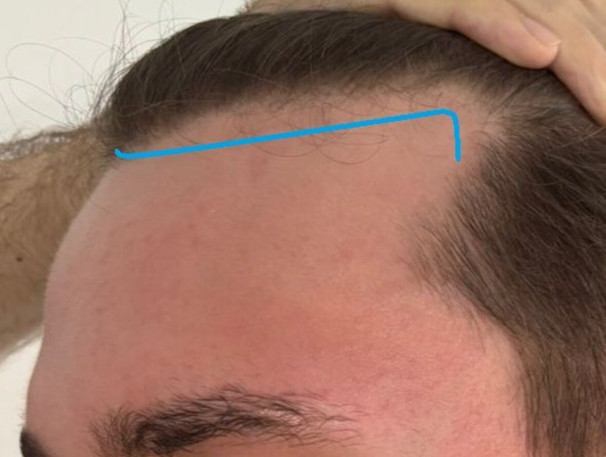Looking for help selecting a surgeon for hairline restoration for NW 2 ...
