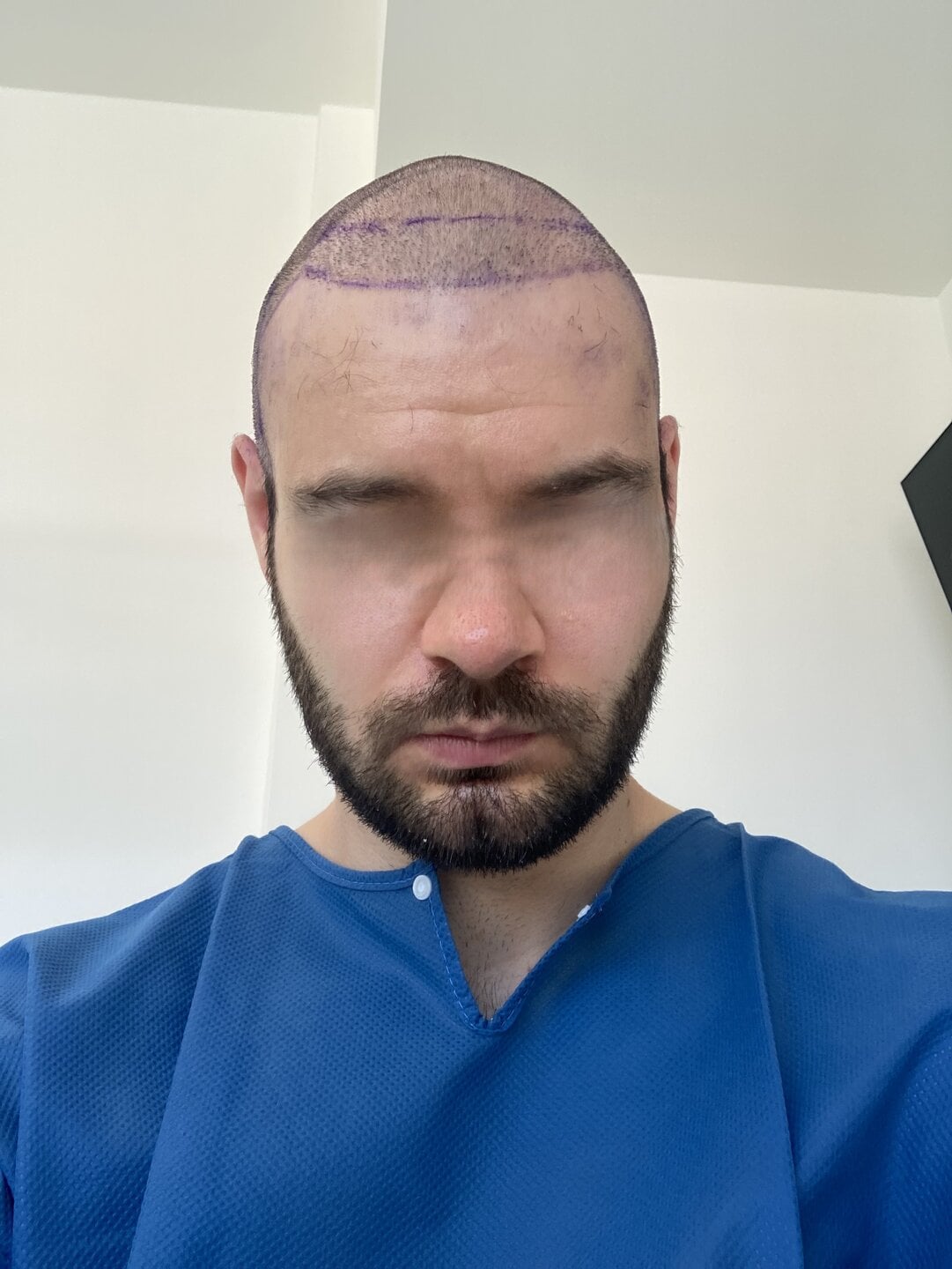 1731 tough FUE grafts including 308 beard at Trichogenics for ...