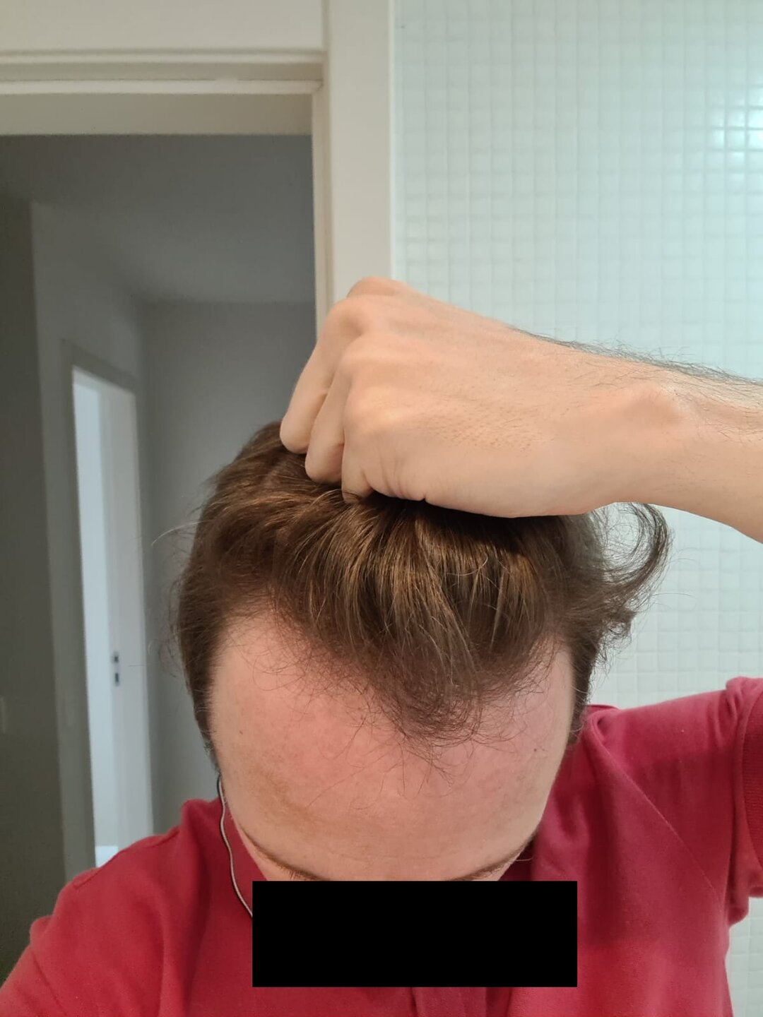 Surgery upcoming. This doc usually does a lot of grafts, is 5k too much ...