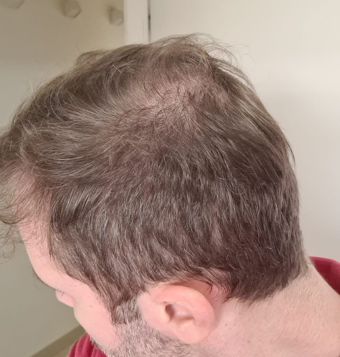 Surgery upcoming. This doc usually does a lot of grafts, is 5k too much ...
