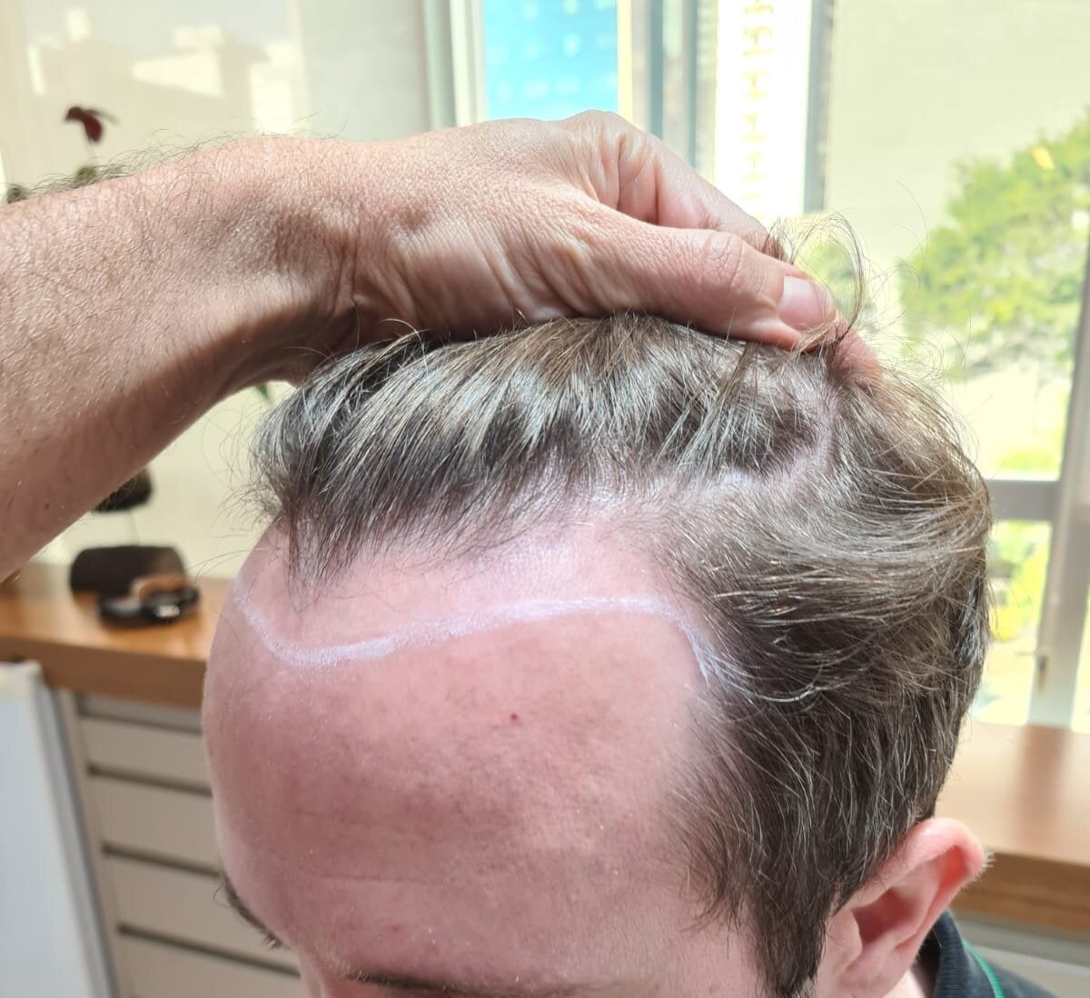 Surgery upcoming. This doc usually does a lot of grafts, is 5k too much ...