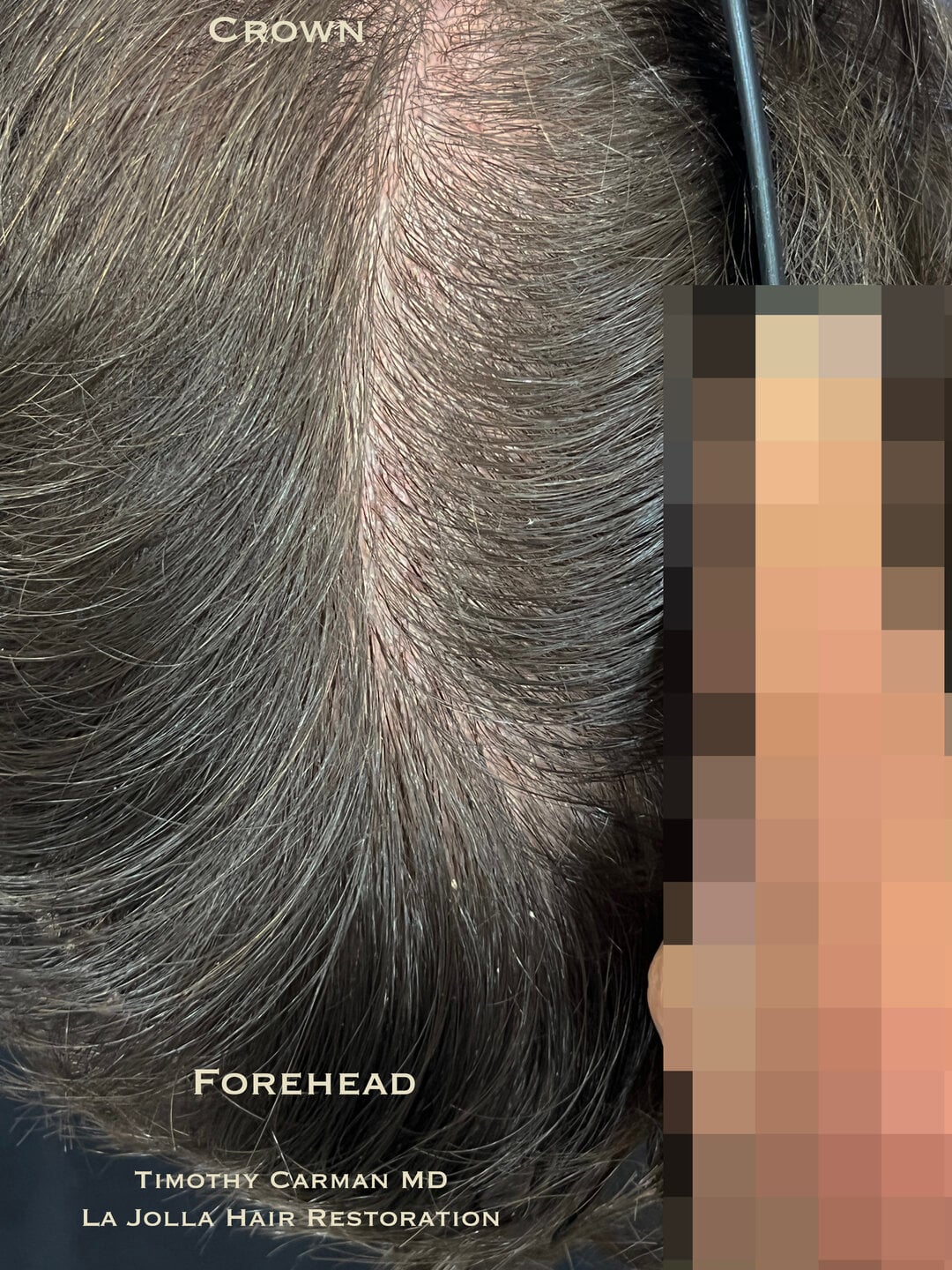 Dr Timothy Carman Hairline, Frontal Forelock, Midscalp and Crown ...