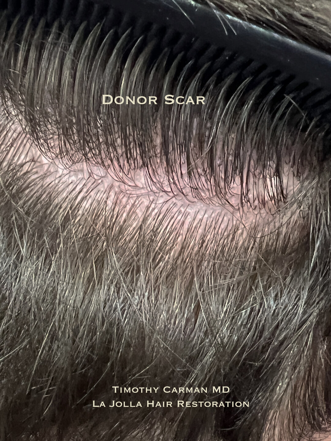 Dr Timothy Carman Hairline, Frontal Forelock, Midscalp and Crown ...