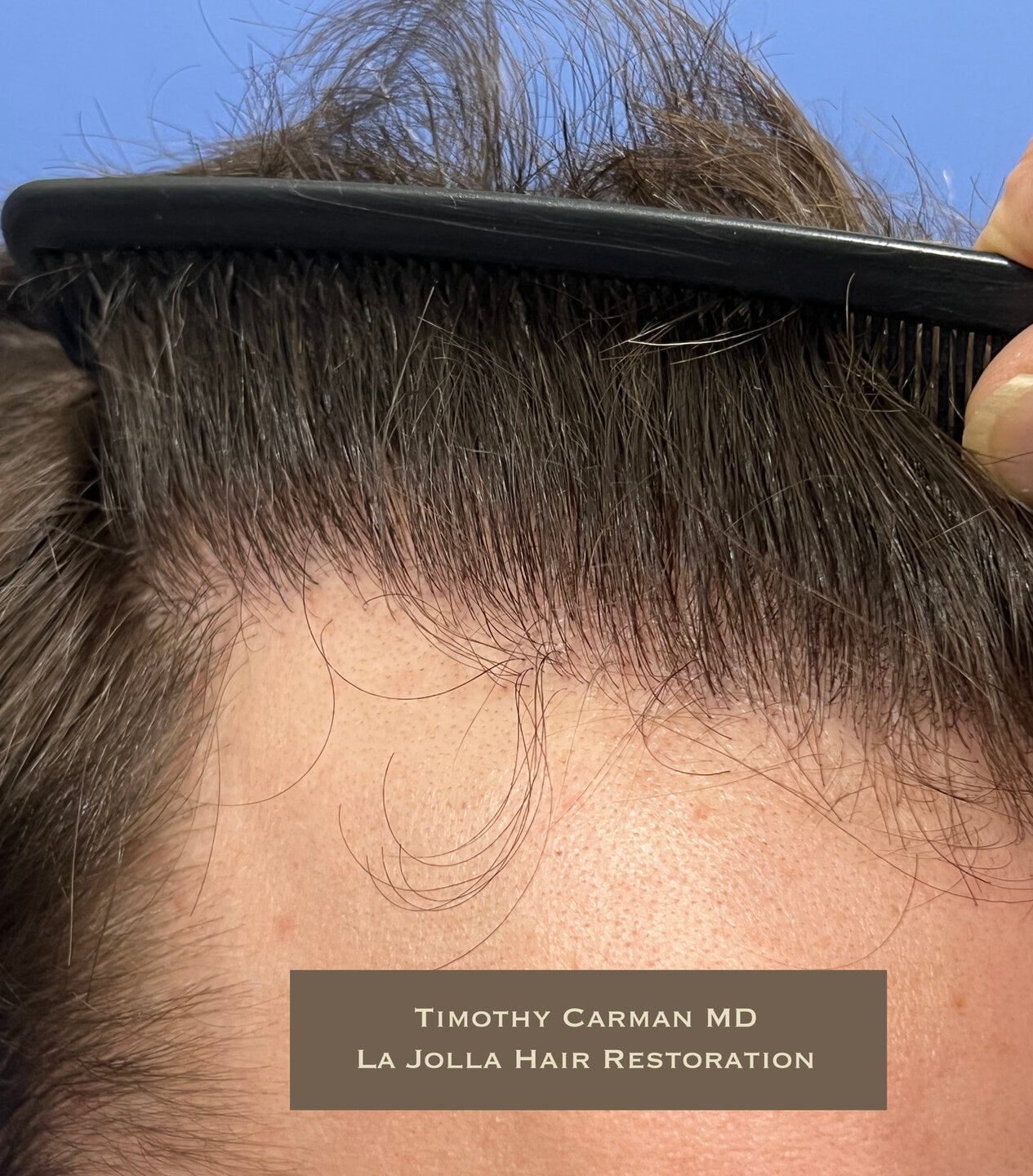 Dr Timothy Carman Hairline, Frontal Forelock, Midscalp and Crown ...