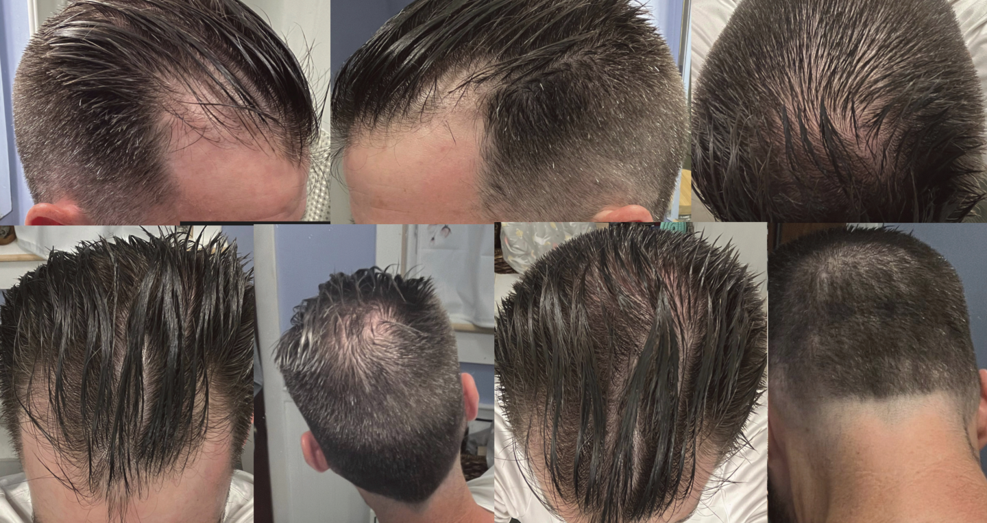Seeking Hair Transplant / Treatment Advice - Hair Restoration Questions ...