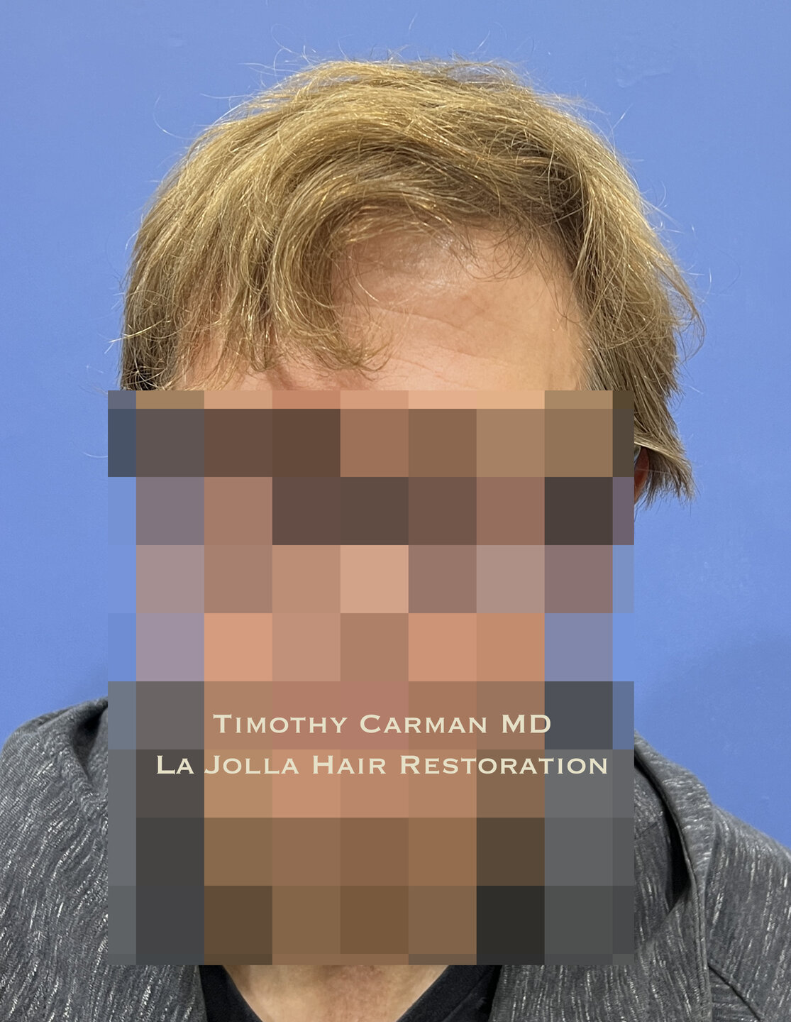Dr Timothy Carman Hairline and Frontal Forelock Reconstruction 1834 FU ...