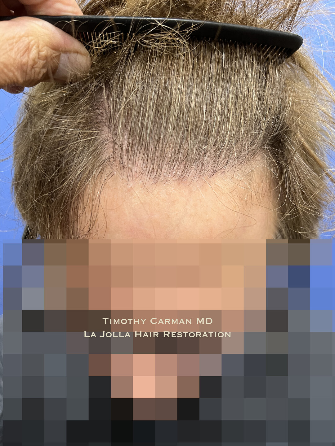 Dr Timothy Carman Hairline and Frontal Forelock Reconstruction 1834 FU ...