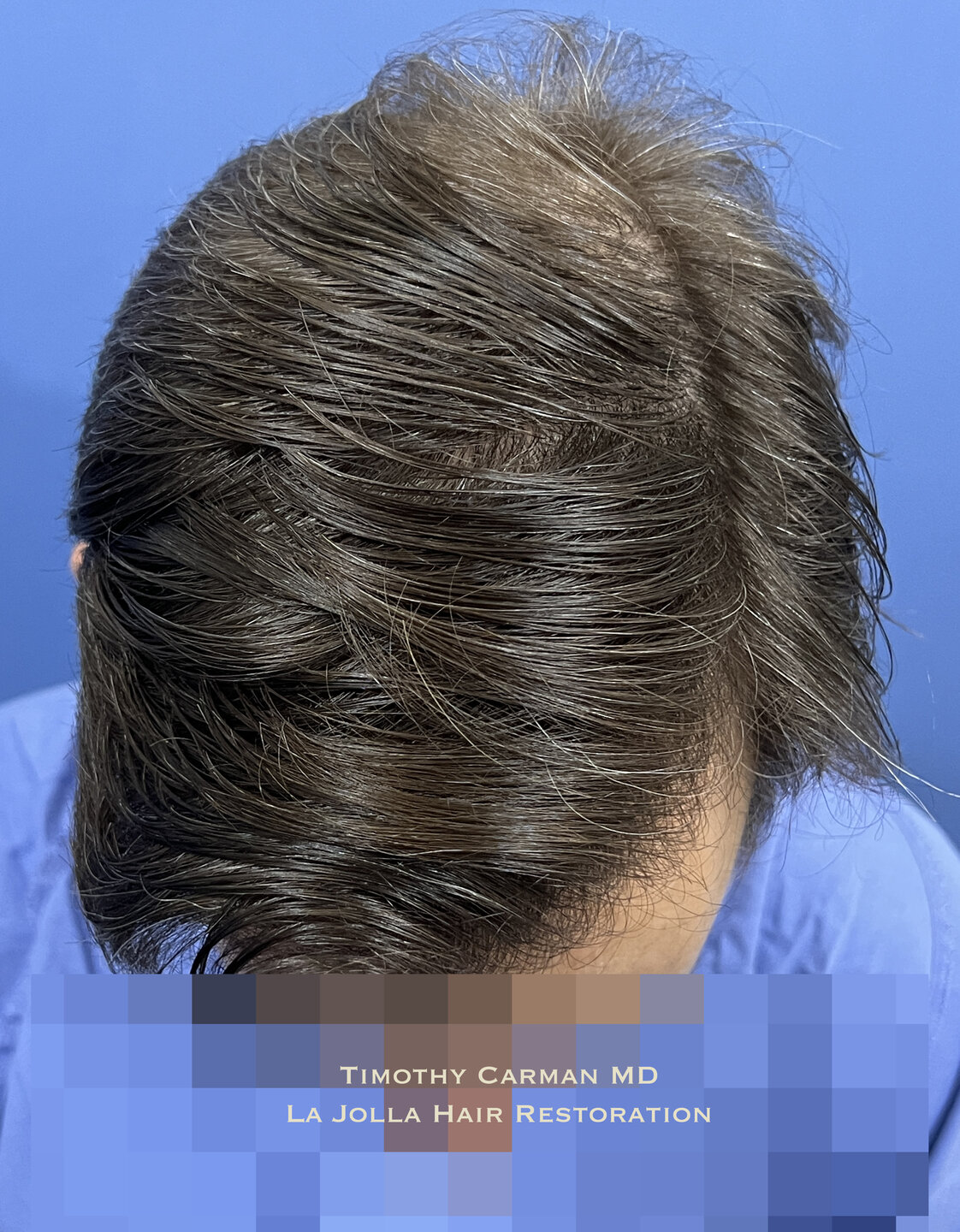 Dr Timothy Carman Hairline, Frontal forelock, Midscalp and Crown ...