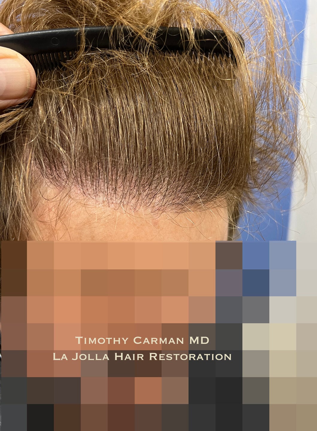 Dr Timothy Carman Hairline and Frontal Forelock Reconstruction 1834 FU ...