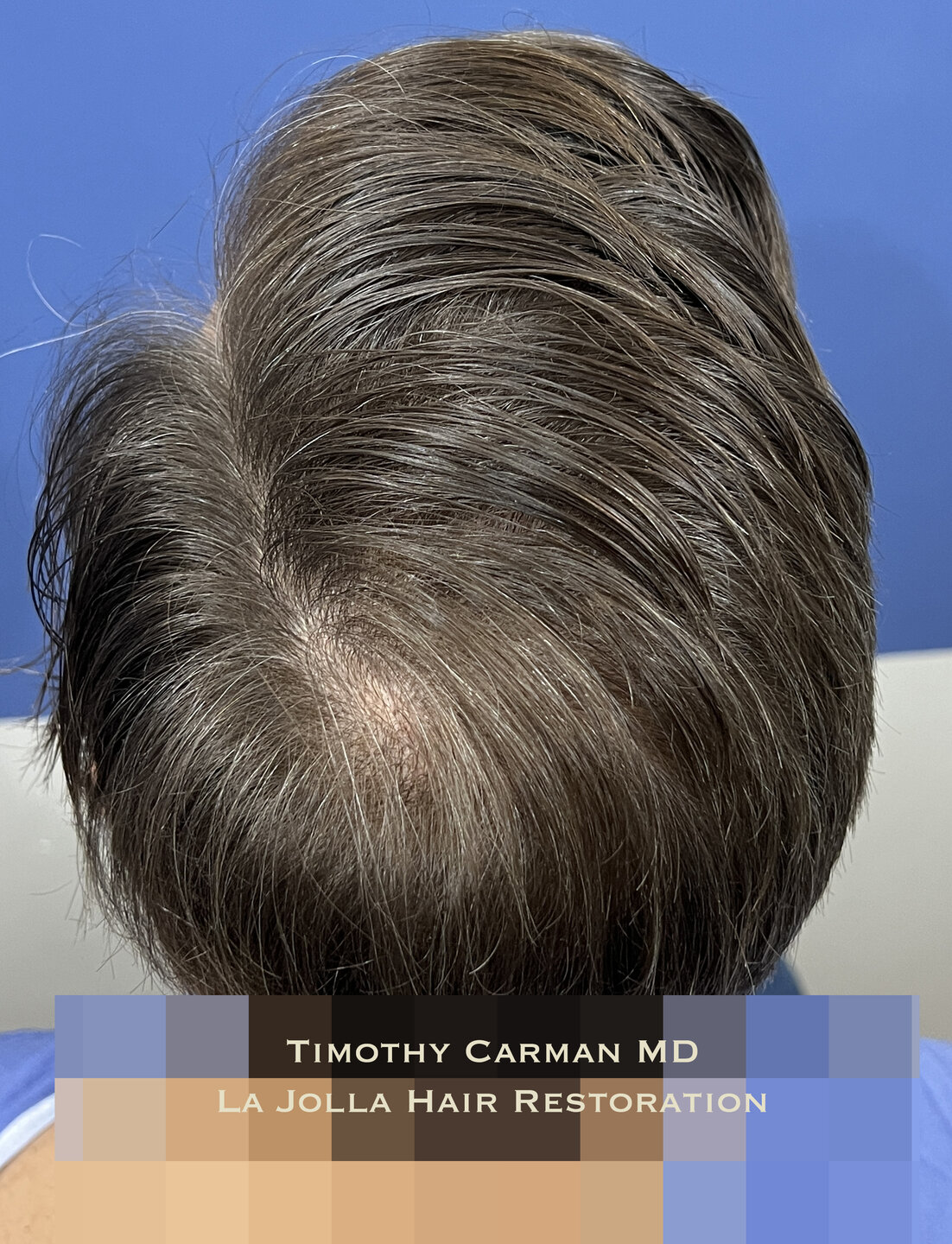 Dr Timothy Carman Hairline, Frontal forelock, Midscalp and Crown ...