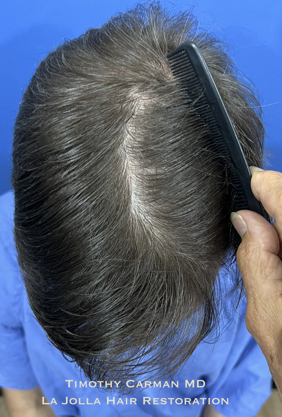 Dr Timothy Carman Hairline, Frontal forelock, Midscalp and Crown ...