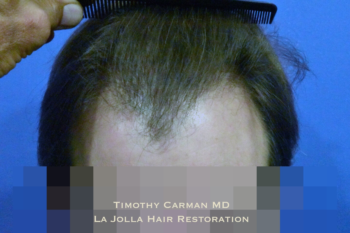 Dr Timothy Carman Hairline, Frontal forelock, Midscalp and Crown ...