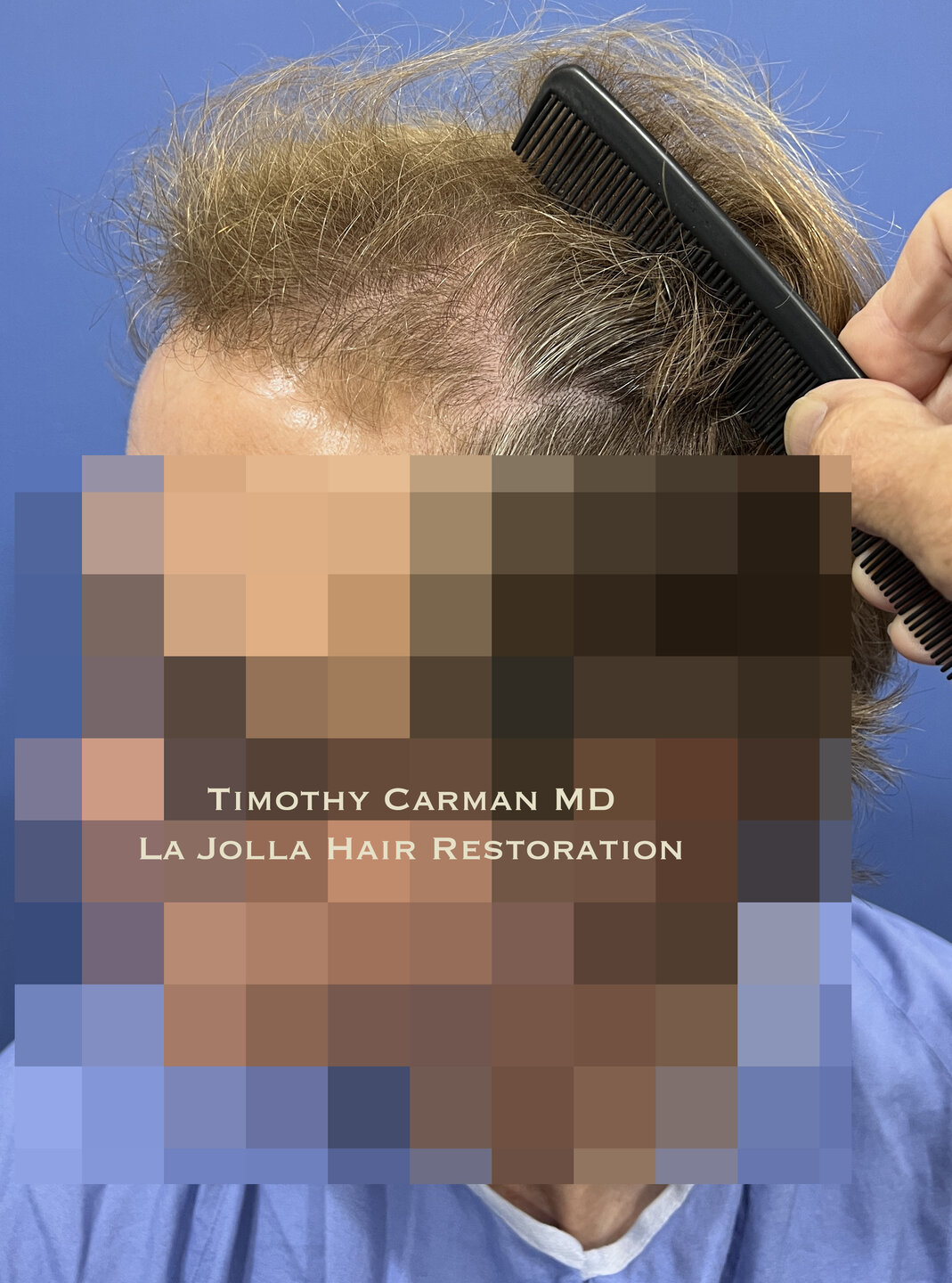 Dr Timothy Carman Hairline and Frontal Forelock Reconstruction 1834 FU ...