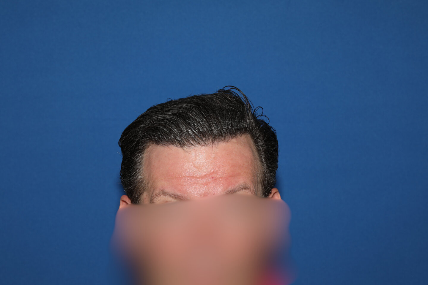 Bhumik Shah MD | 2400 FU grafts Hairline Rebuilding | New Jersey ...