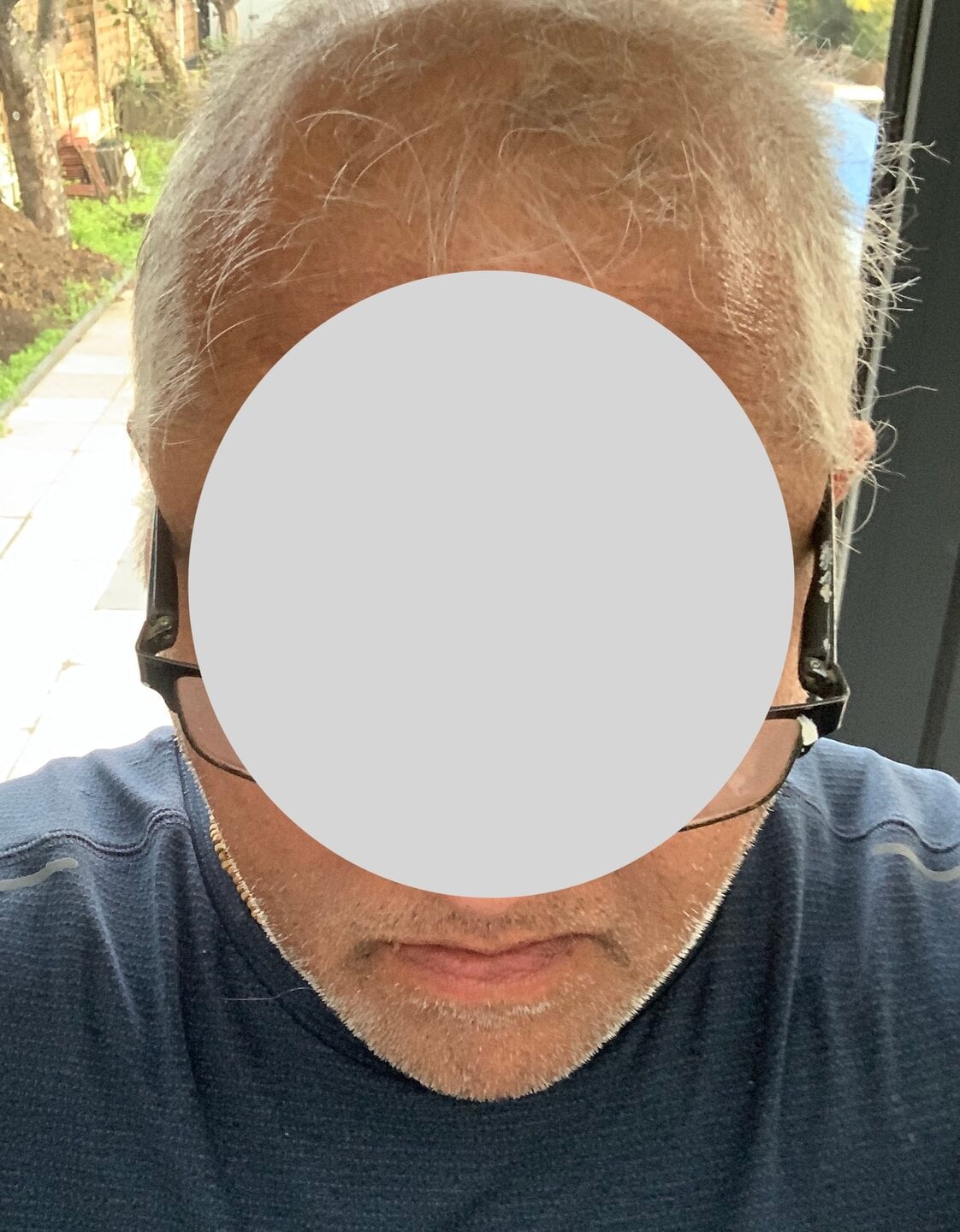 Consultation With Dr Sethi Of Eugenix... - Hair Restoration Questions ...