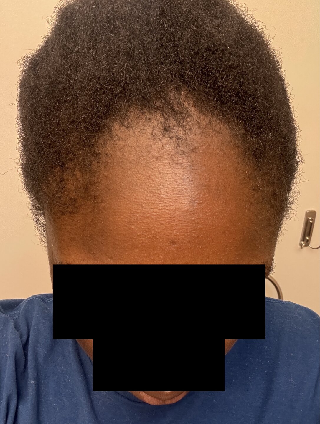 Surgeon recommendation for afro female hair loss - Hair Restoration ...