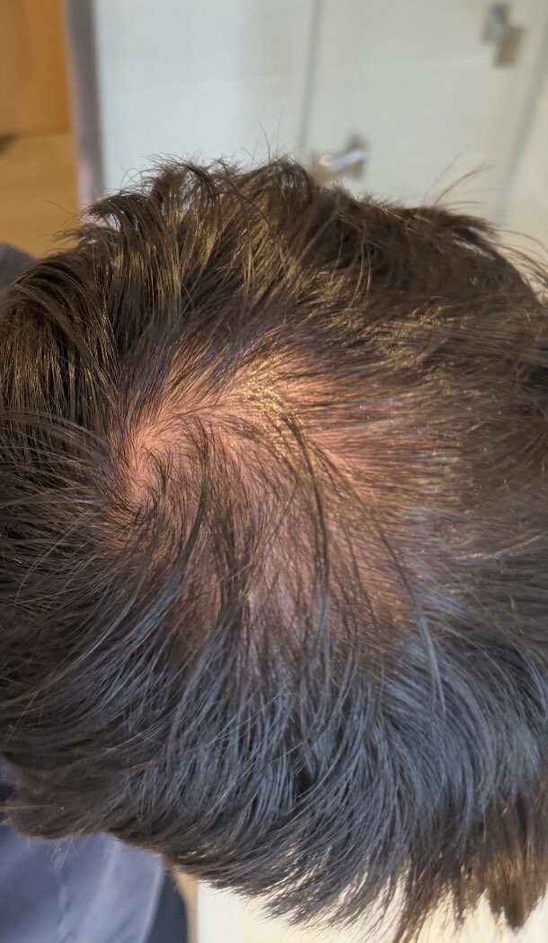 Experiences with Crown/Vertex Hair Thickening - Hair Restoration ...