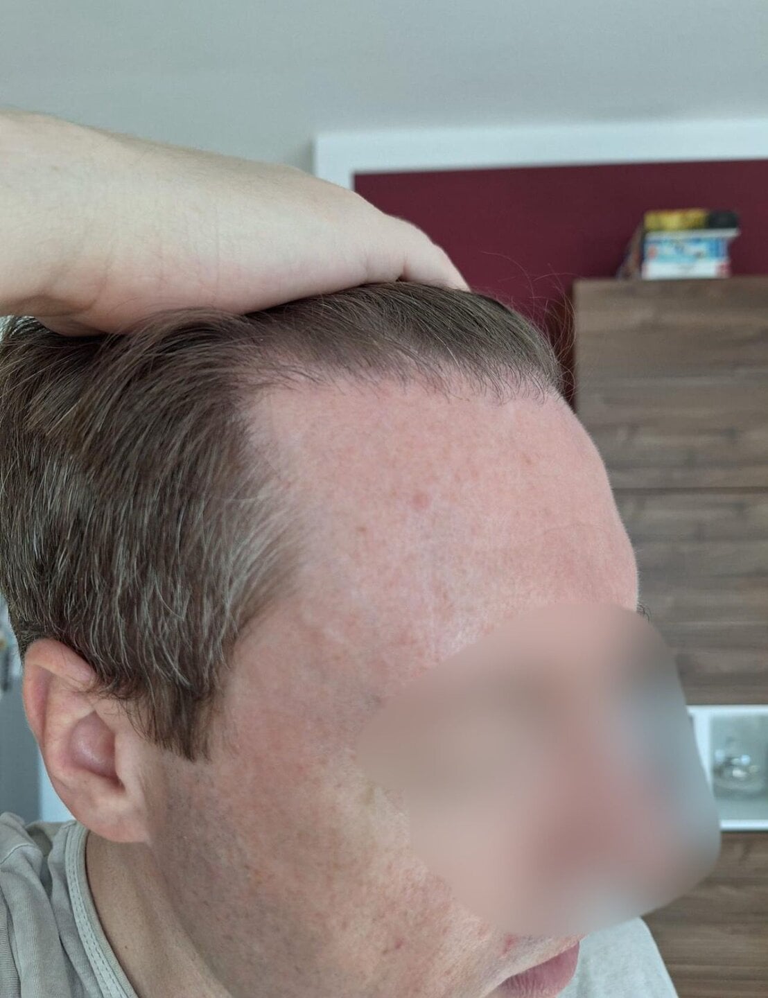 Ozlem Bicer MD-Hair Transplant-3430 Grafts FUE by micro-motor, 9 ...