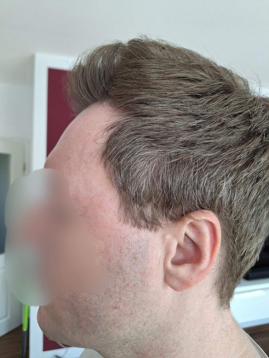 Ozlem Bicer MD-Hair Transplant-3430 Grafts FUE by micro-motor, 9 ...