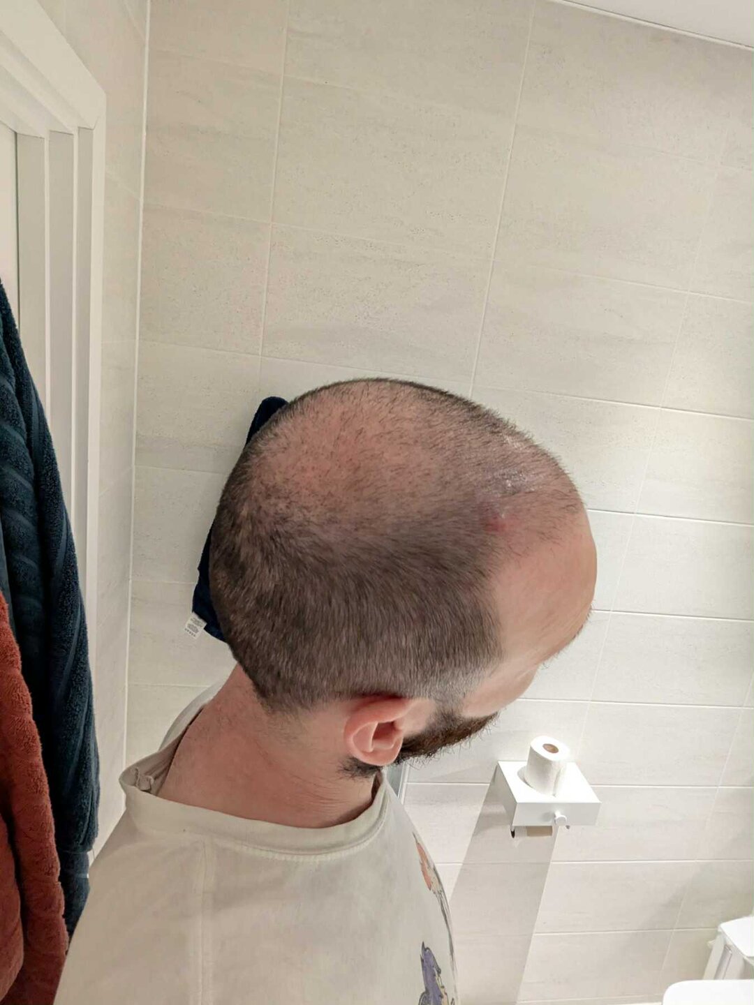 Choiexpert , 4827 grafts , Dr Chris , 08-09/09/2025 , 2 days session ...