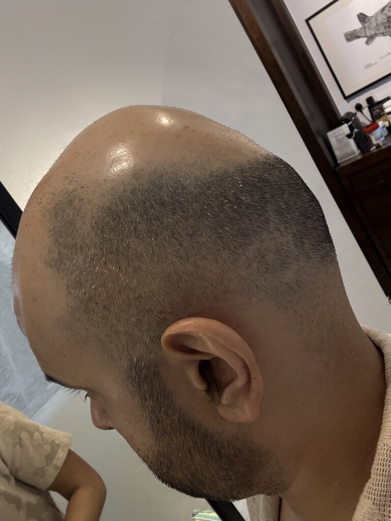 NW7 | Dr. Das (Eugenix, Gurgaon) | Surgery Scheduled Dec 2025 - Hair ...