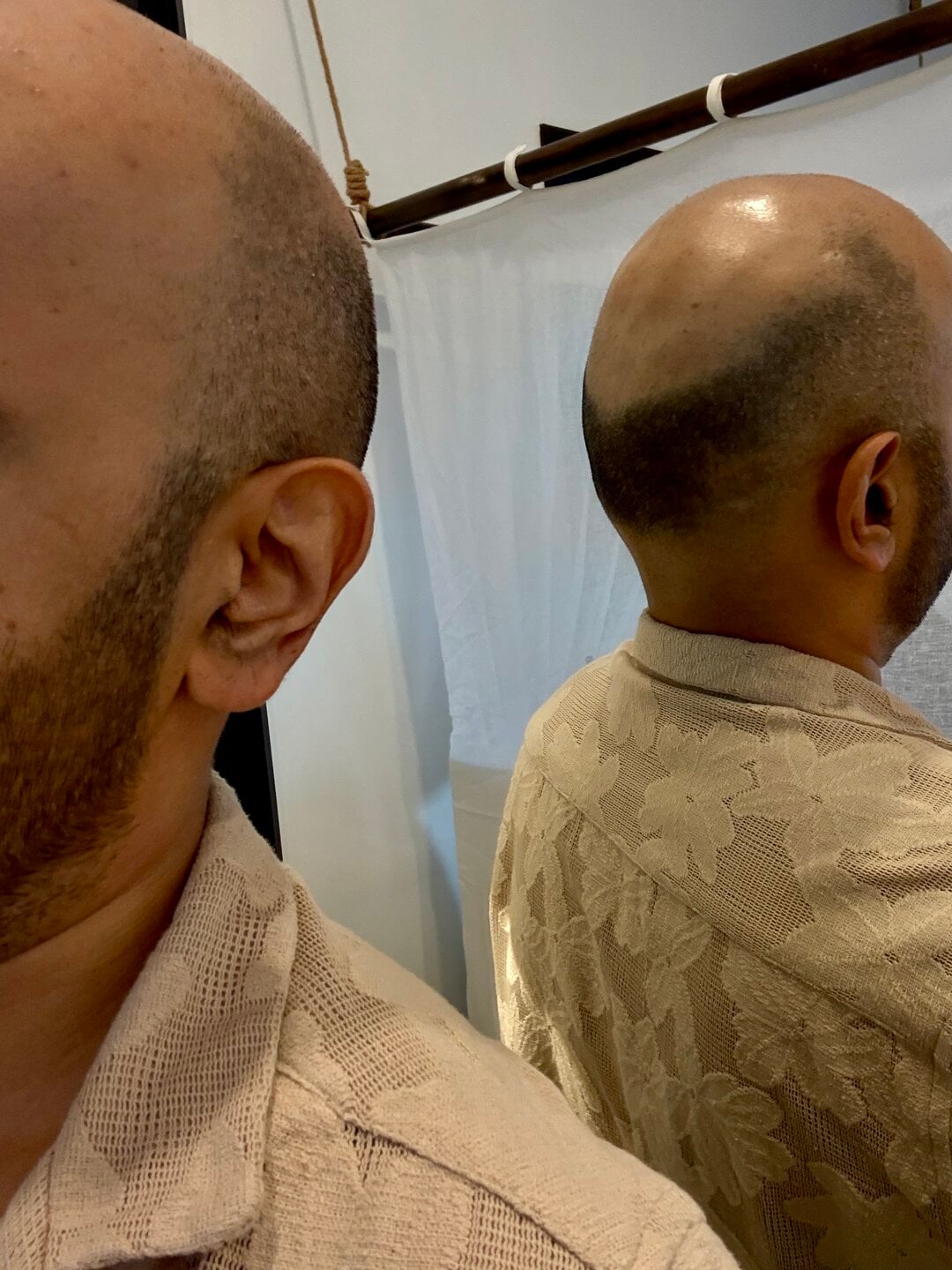 NW7 | Dr. Das (Eugenix, Gurgaon) | Surgery Scheduled Dec 2025 - Hair ...