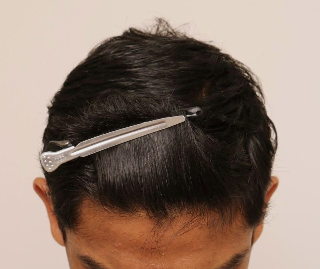 Dr. Robert Dorin ~ FUE session treating temporal and hairline recession ...