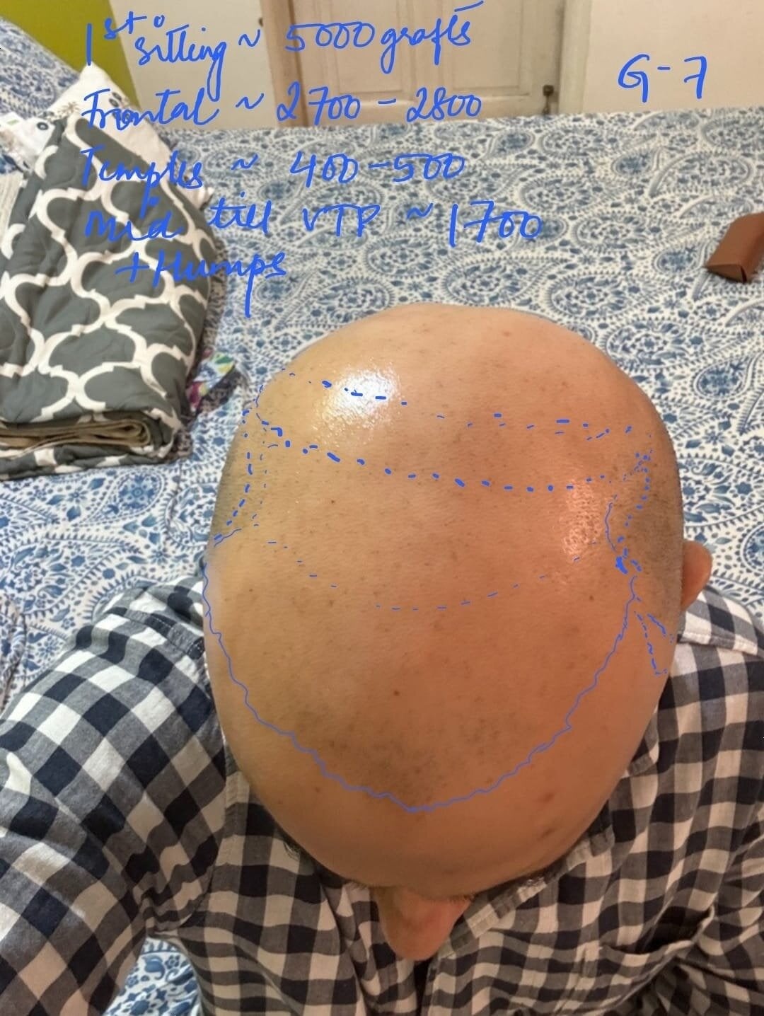 NW7 | Dr. Das (Eugenix, Gurgaon) | Surgery Scheduled Dec 2025 - Hair ...