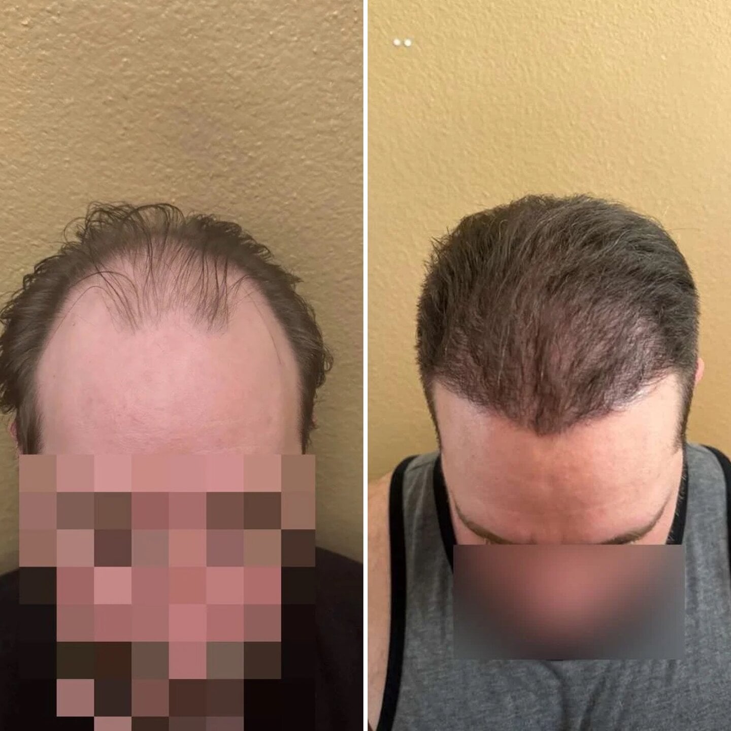 Dr. Felipe Pittella | 13,354 Grafts / 26,542 Total Hairs | NW 6? | 38 ...