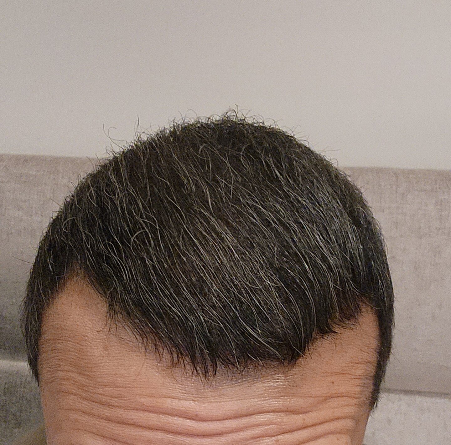 Dr. Felipe Pittella FUE/12,413 grafts/Oct 3rd and 4th, 2024 - Page 5 ...