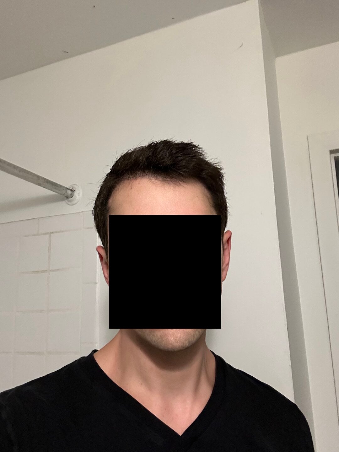 Dr. Blake Bloxham left me with a bad hairline, seeking advice on next ...