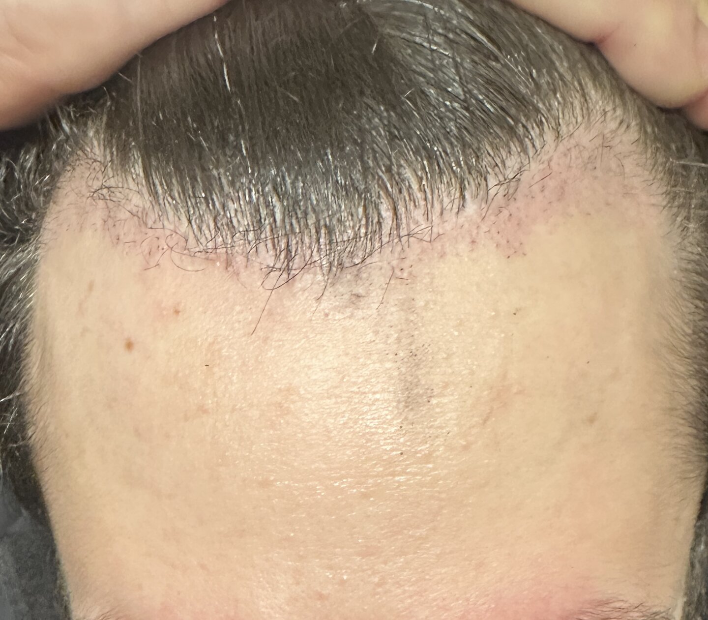 Dr. Blake Bloxham left me with a bad hairline, seeking advice on next ...