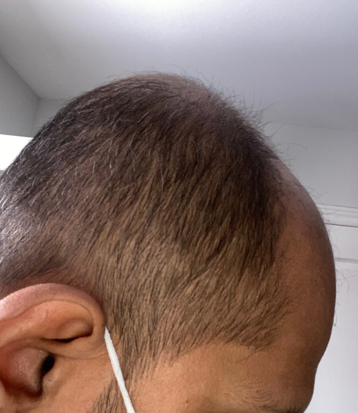 Hair restoration possible or not? - Hair Restoration Questions and ...