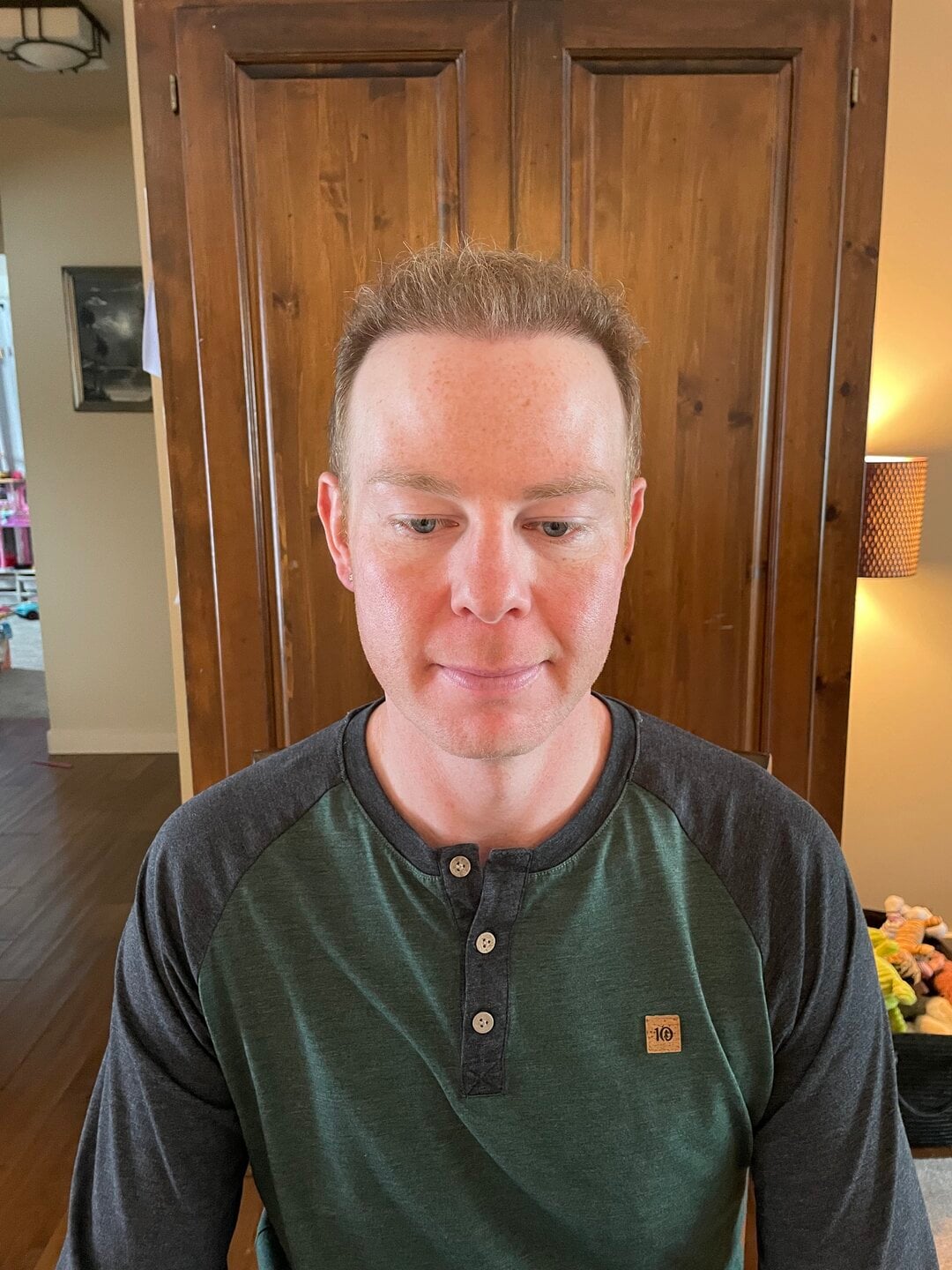 NW7, Age 44, Limited Budget – Hair Transplant Worth It? - Hair ...