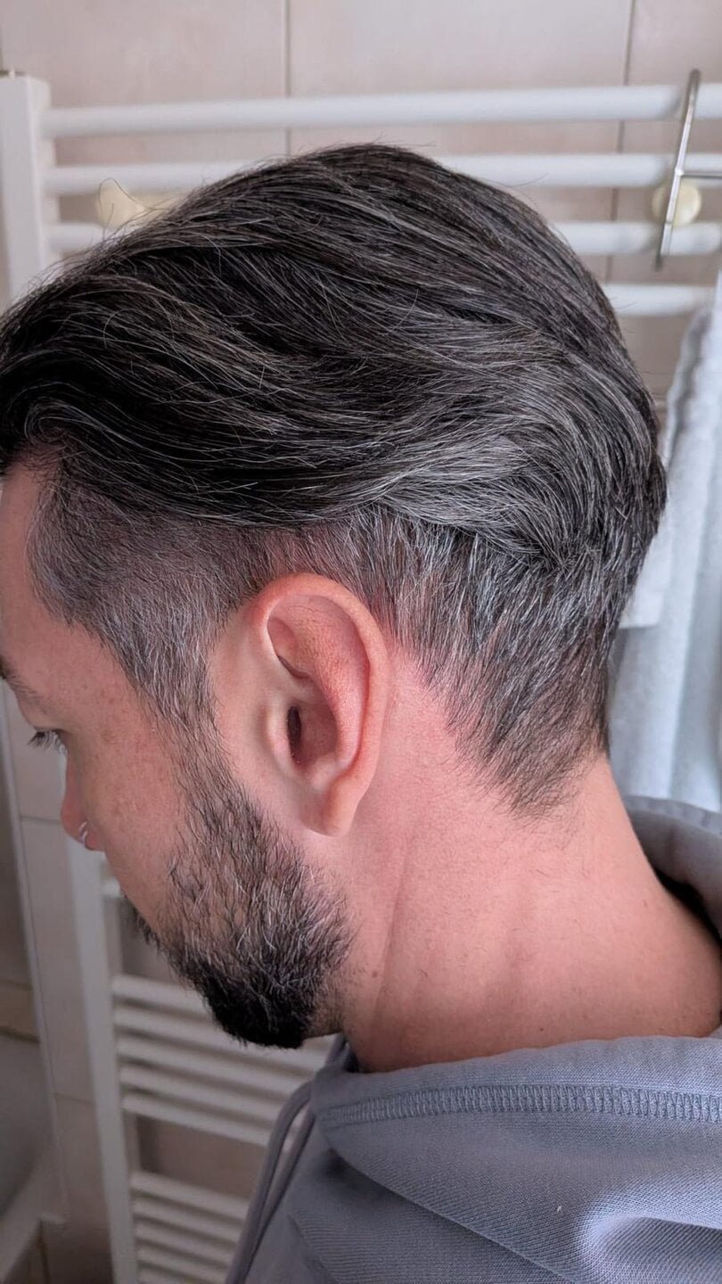 Ozlem Bicer MD-Hair Transplant-2640 Grafts FUE by micro-motor, 12 ...