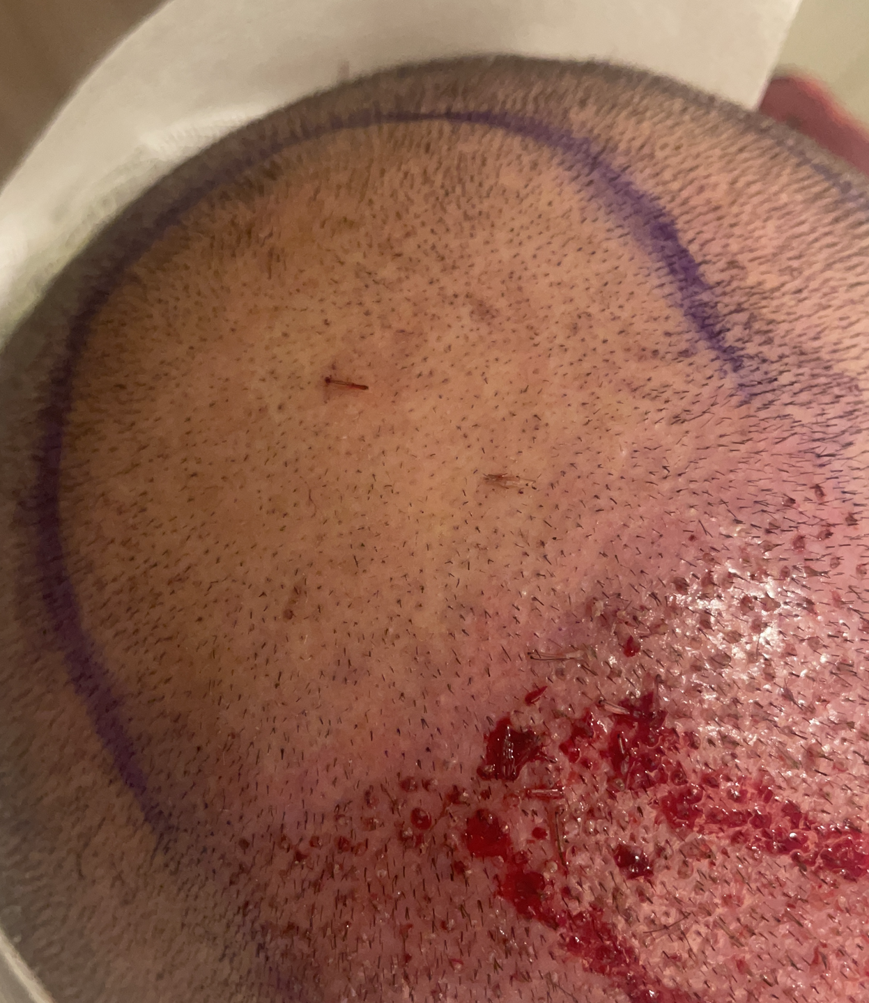 Dr Jean Luc Portelli - 5100 grafts - Hair Transplant Reviews - Hair ...
