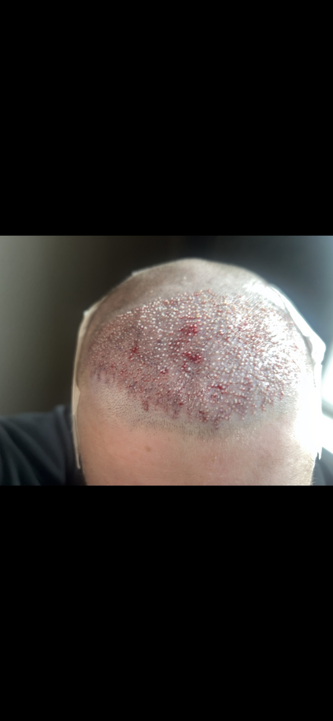 7 months post HT -> Bad growth center of frontal third - Hair ...