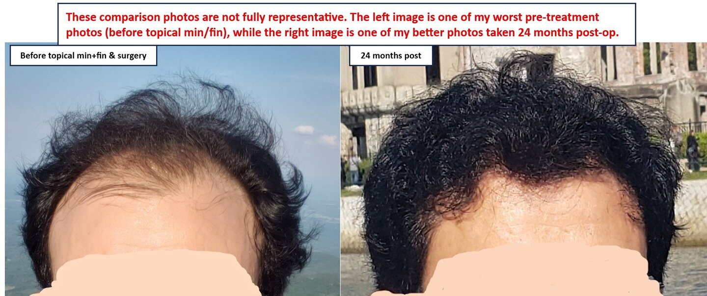 3500 FUT with Dr. Bloxham : A Two-Year Update - Hair Transplant Reviews ...