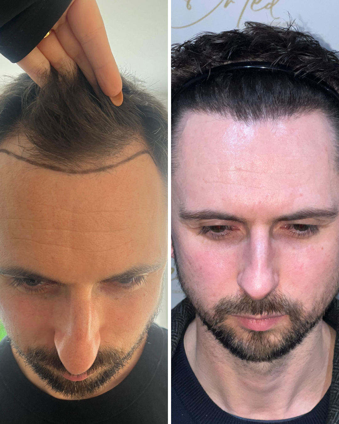 Dr Ted Miln (UK) | 1,666 graft FUE | soft, natural hairline restoration ...