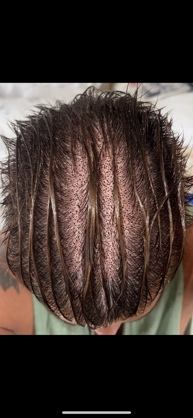 Dr Micaela Iniguez (MicaClinic) - Buenos Aires,Argentina - 1.000 grafts ...
