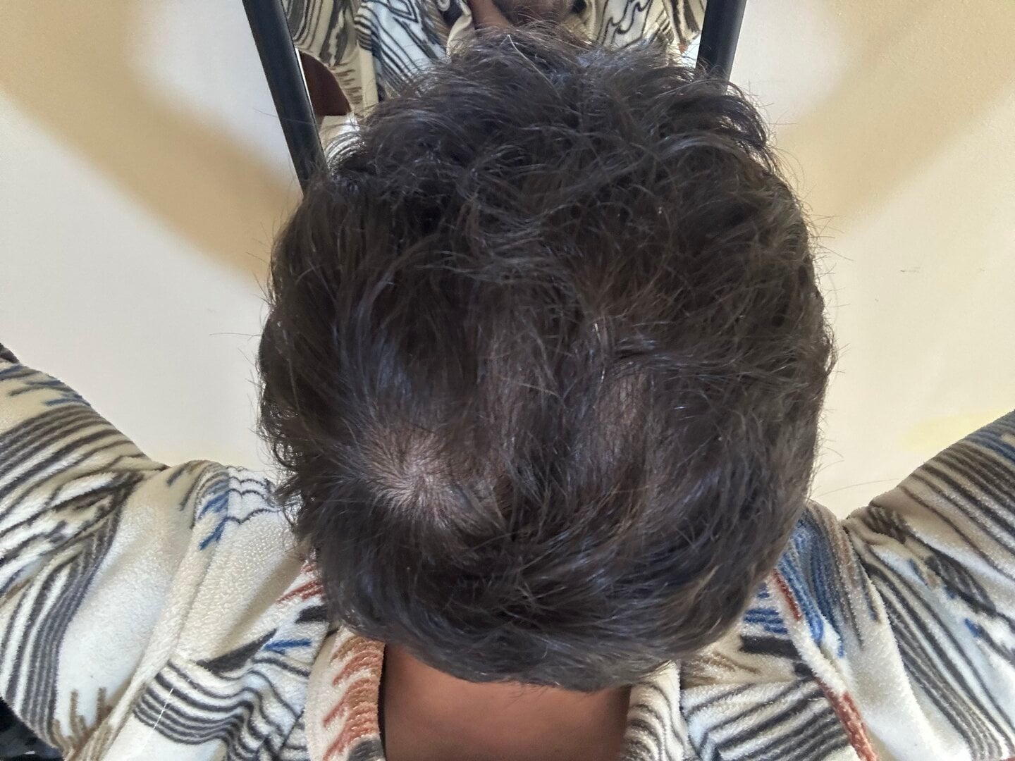 Help me understand how my crown looks like - Hair Restoration Questions ...