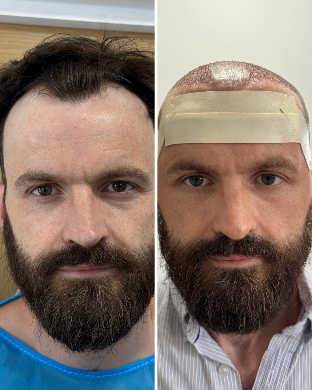 Dr Ted Miln (UK) | 3,443 graft FUE | Spectacular 30 week (6 month) Hair ...