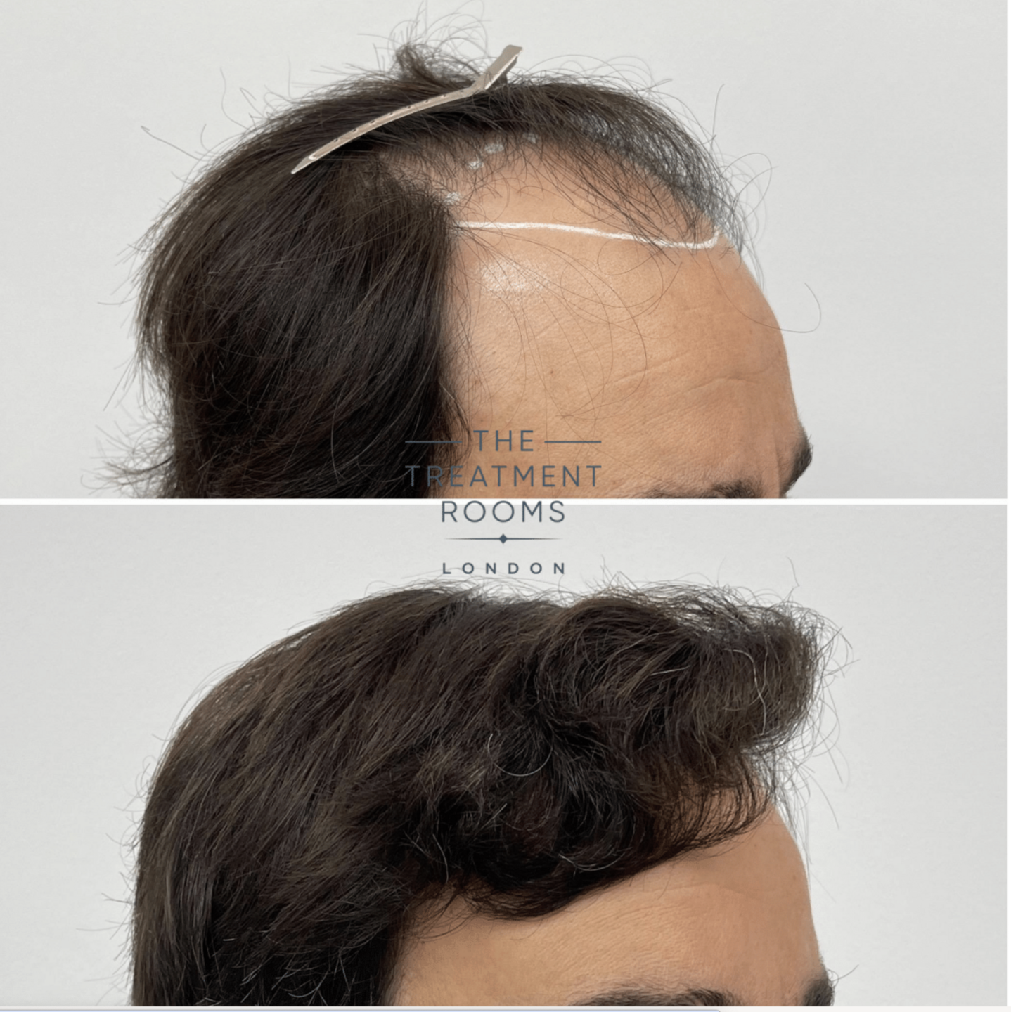 The Treatment Rooms, London | Dr Vara | 2148 FUE Grafts | Hairline ...