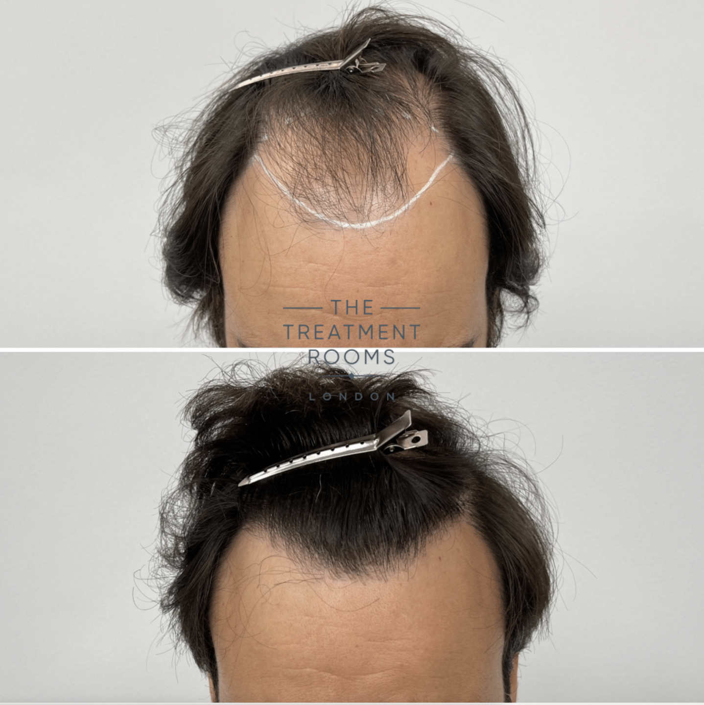 The Treatment Rooms, London | Dr Vara | 2148 FUE Grafts | Hairline ...