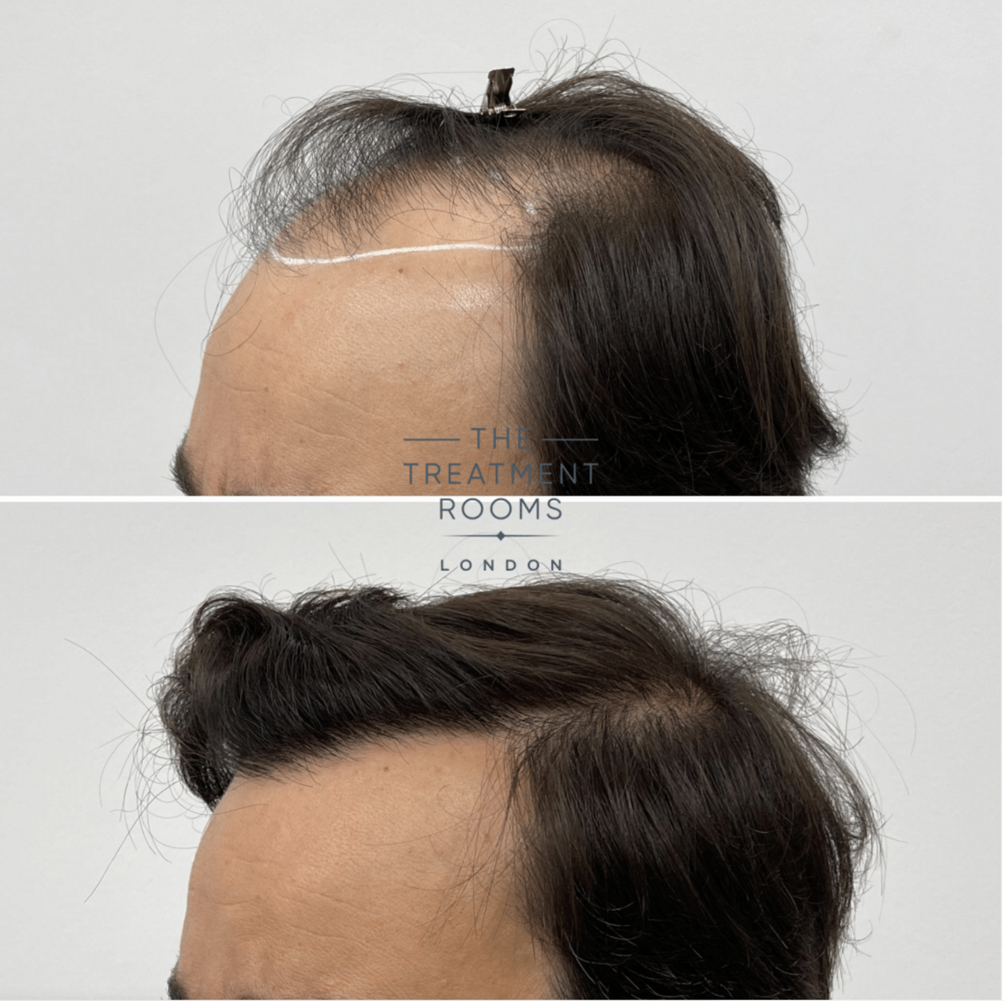 The Treatment Rooms, London | Dr Vara | 2148 FUE Grafts | Hairline ...